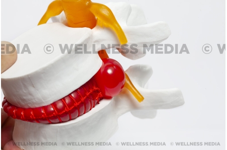 Lumbar Spine Disc Herniation Anatomical Model