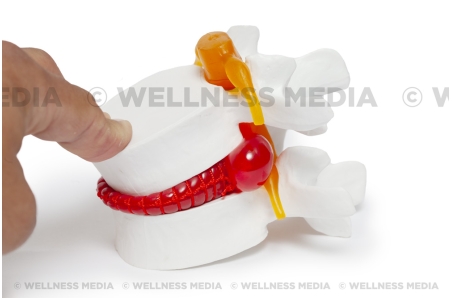 Lumbar Spine Disc Herniation Anatomical Model