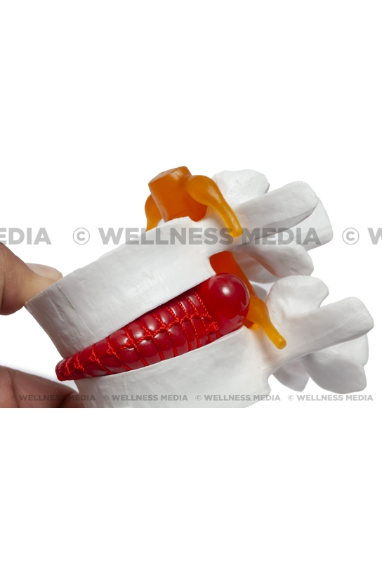 Lumbar Spine Disc Herniation Anatomical Model