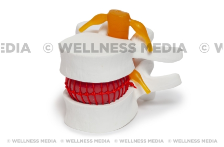 Lumbar Spine Disc Herniation Anatomical Model