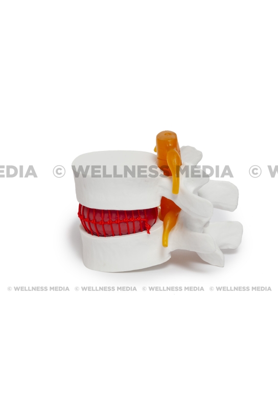 Lumbar Spine Disc Herniation Anatomical Model