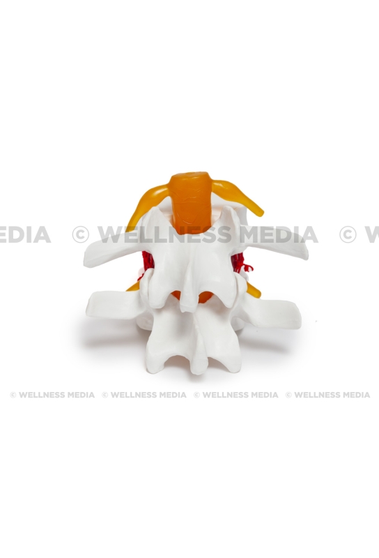 Lumbar Spine Disc Herniation Anatomical Model