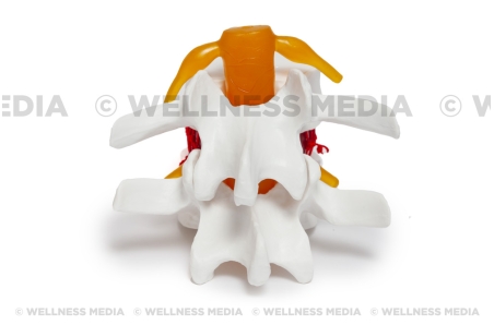 Lumbar Spine Disc Herniation Anatomical Model